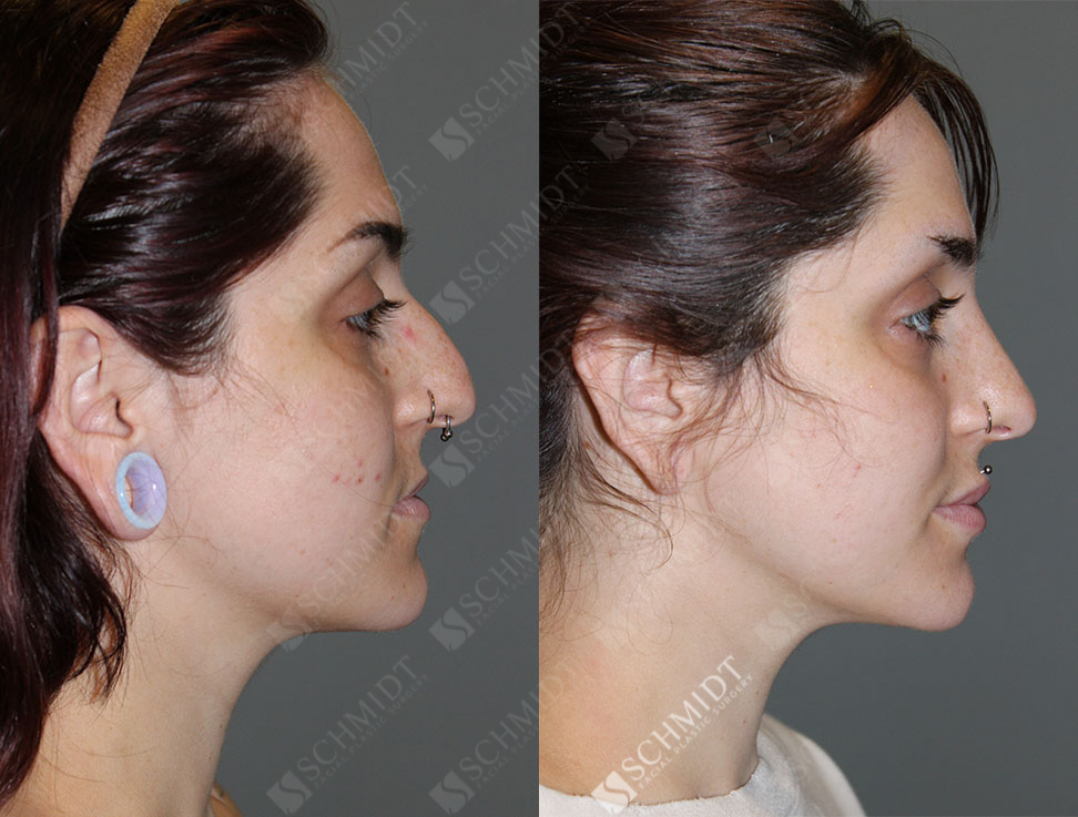 Case 8081 - Schmidt Facial Plastic Surgery