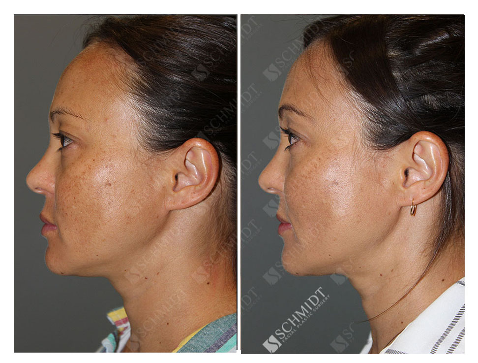 5643 - Schmidt Facial Plastic Surgery