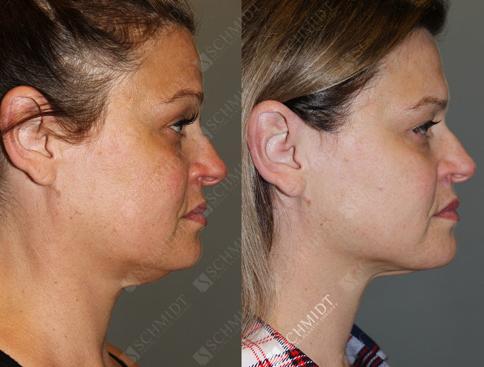 128 - Schmidt Facial Plastic Surgery