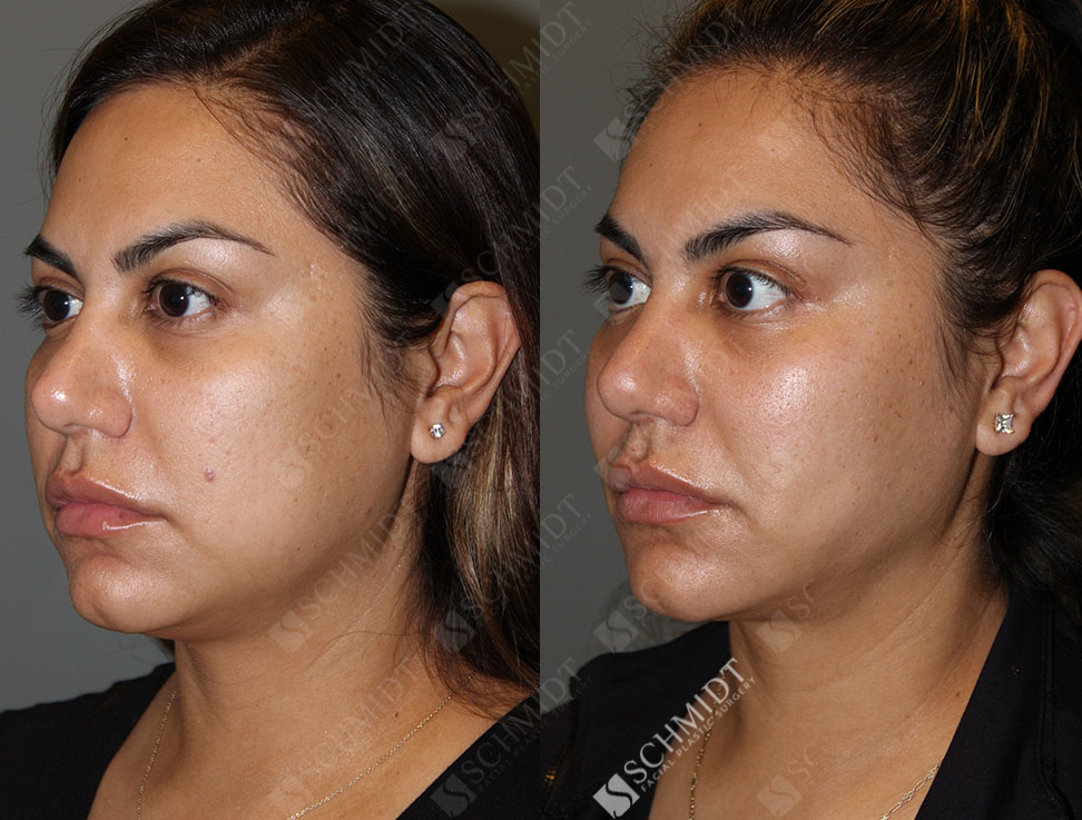 1874 - Schmidt Facial Plastic Surgery