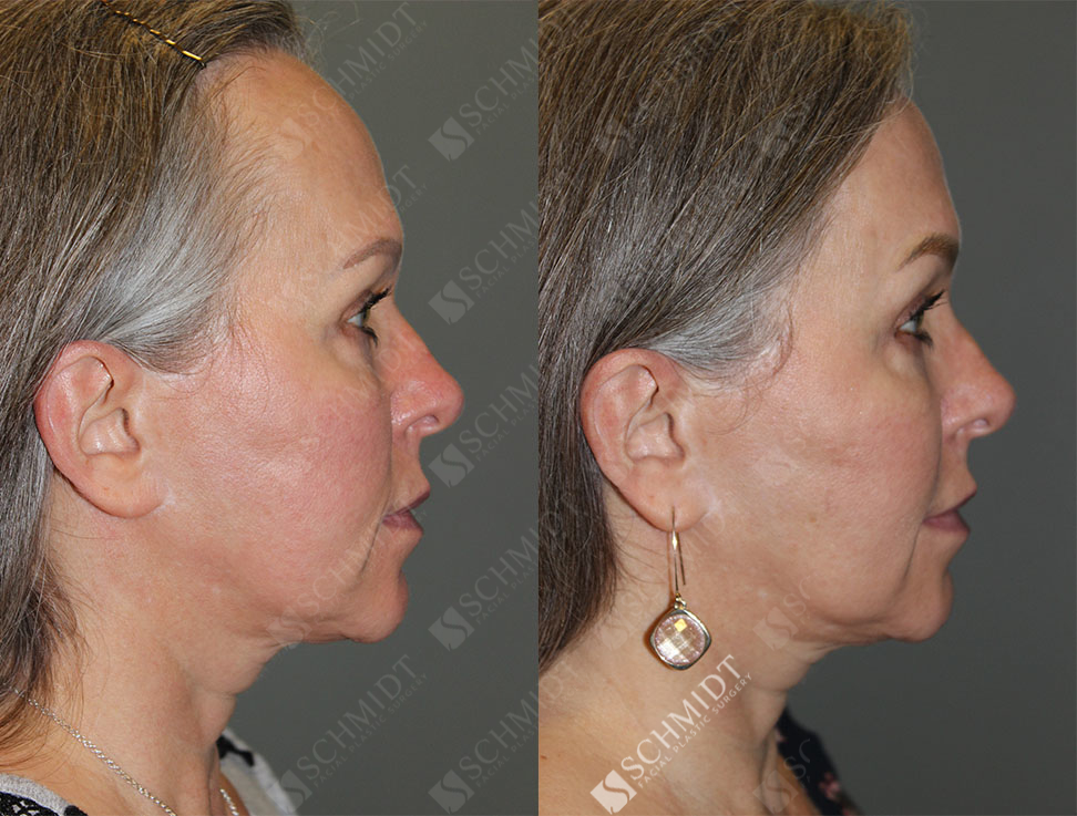 995 - Schmidt Facial Plastic Surgery