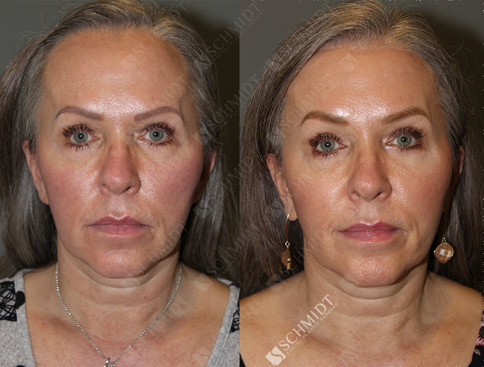 995 - Schmidt Facial Plastic Surgery