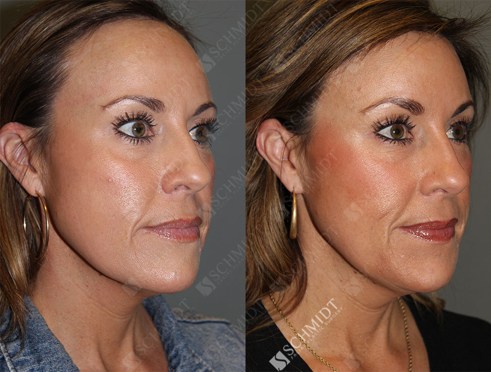 3506 - Schmidt Facial Plastic Surgery