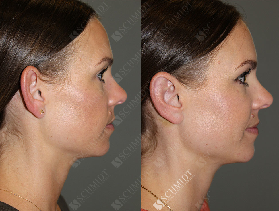 2514 Schmidt Facial Plastic Surgery