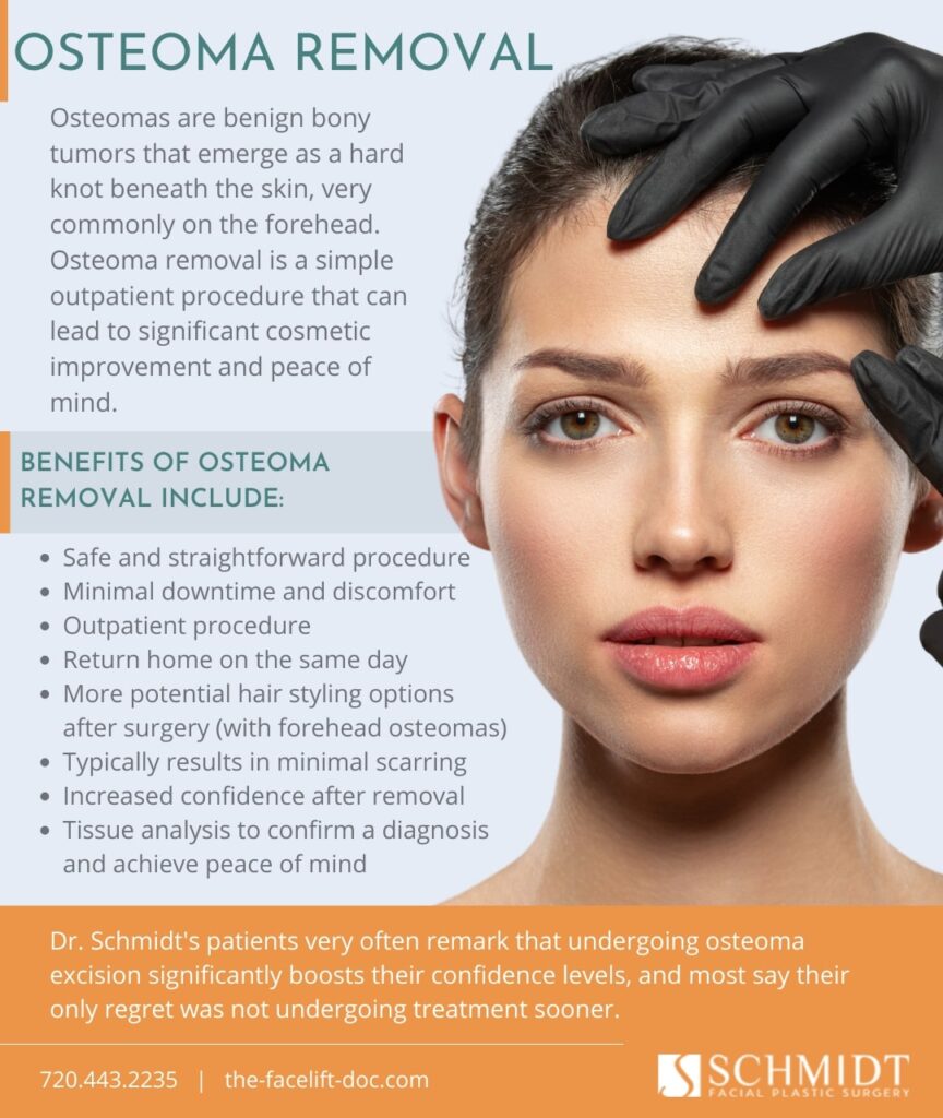 Osteoma Removal in Denver | Schmidt Facial Plastic Surgery