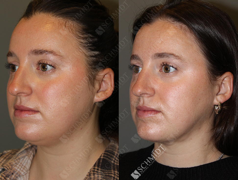 8589 - Schmidt Facial Plastic Surgery