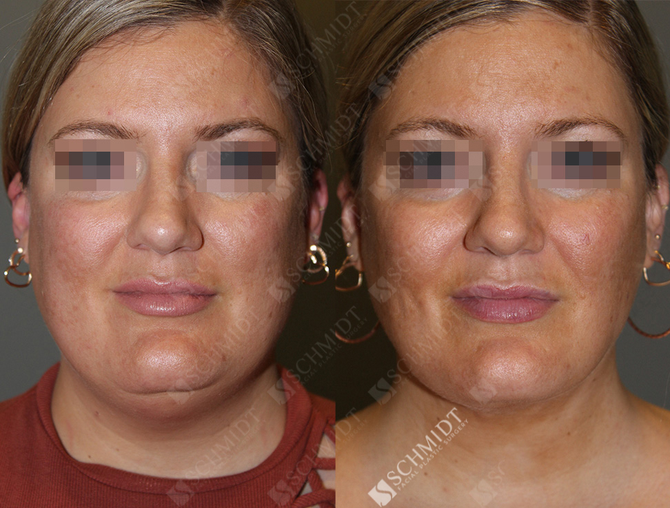 8620 - Schmidt Facial Plastic Surgery