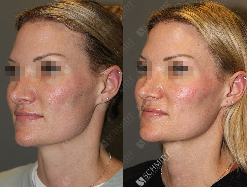 8643 - Schmidt Facial Plastic Surgery