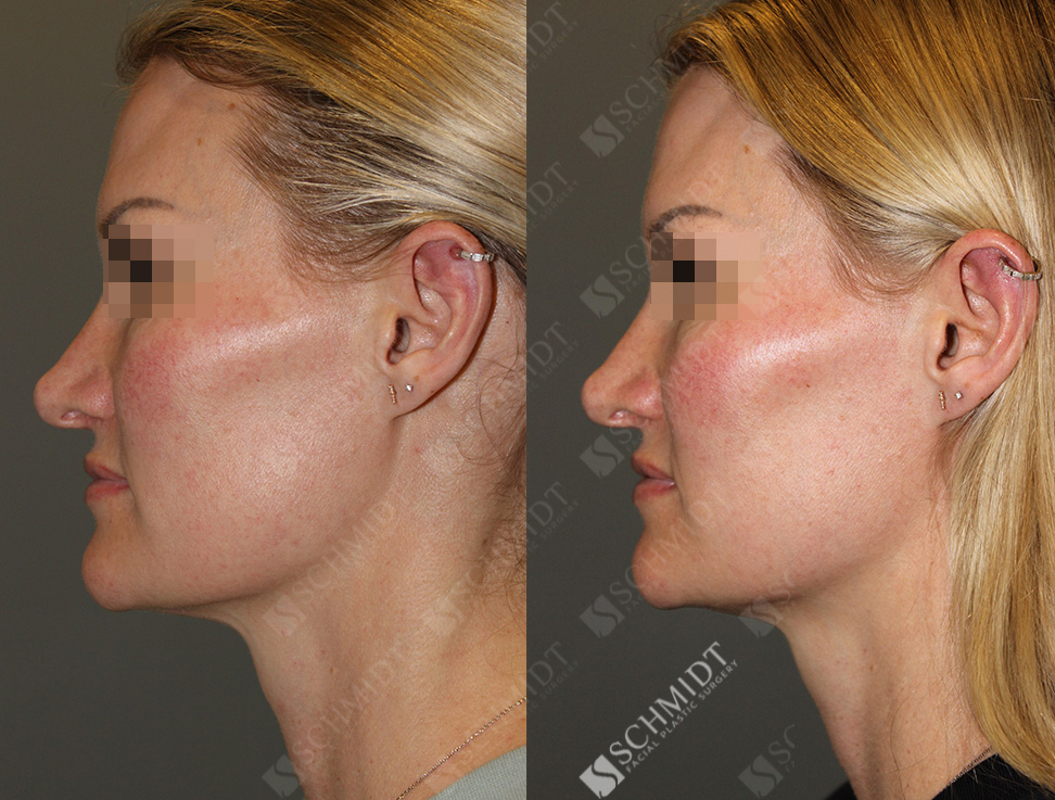 8643 - Schmidt Facial Plastic Surgery