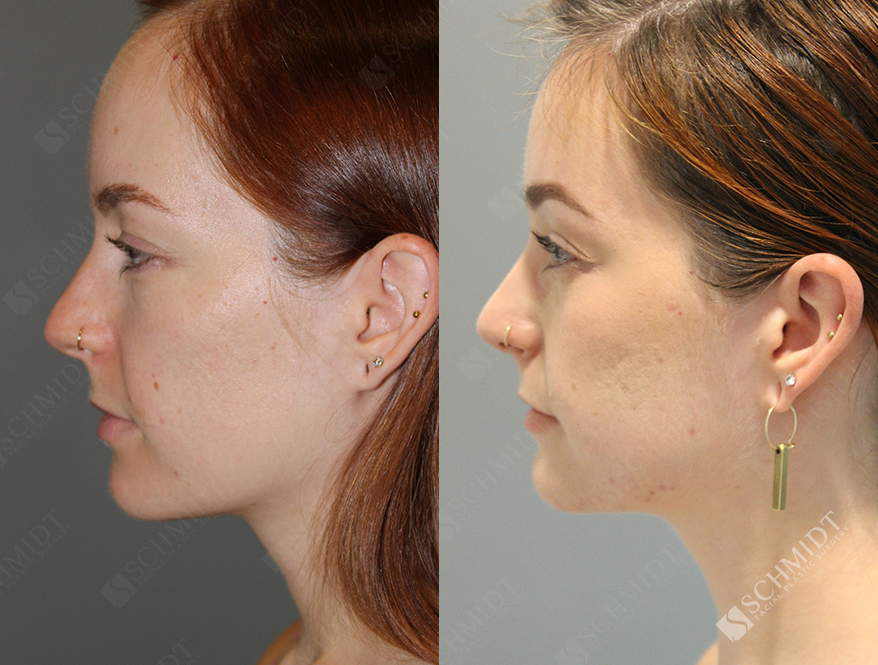 8728 - Schmidt Facial Plastic Surgery