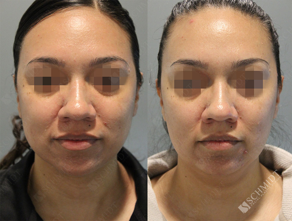 9028 - Schmidt Facial Plastic Surgery