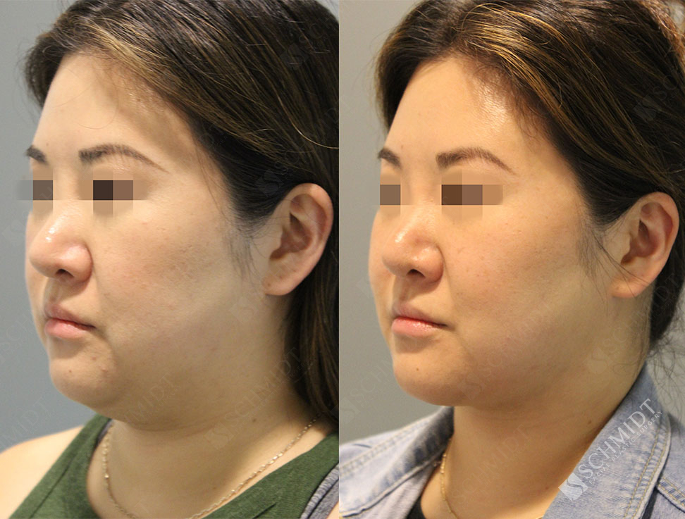 9102 - Schmidt Facial Plastic Surgery