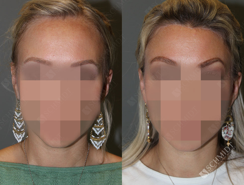 9113 - Schmidt Facial Plastic Surgery