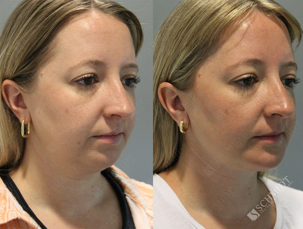 9205 - Schmidt Facial Plastic Surgery