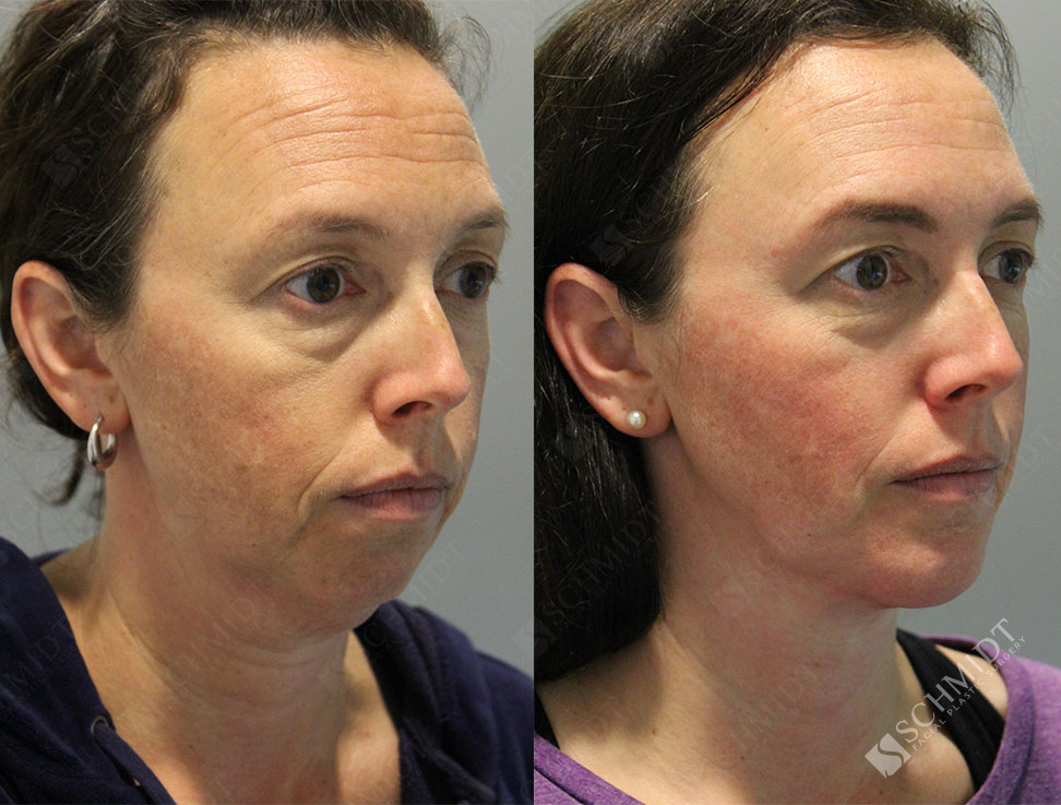 Case 9375 - Schmidt Facial Plastic Surgery