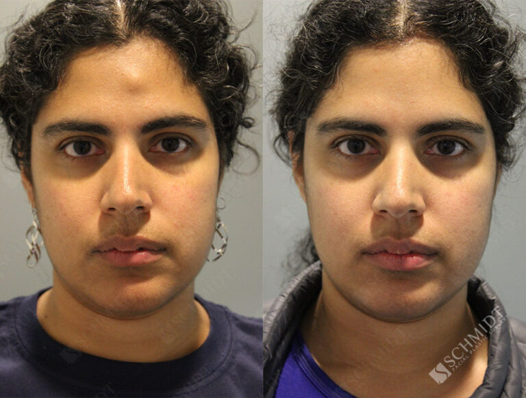 Osteoma Removal Before & After Denver, CO | Dr. Schmidt