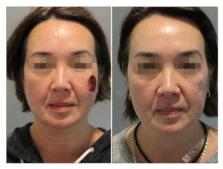 Icon Laser Treatment Before & After Denver, CO | Dr. Schmidt