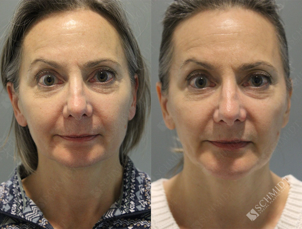 10230 - Schmidt Facial Plastic Surgery