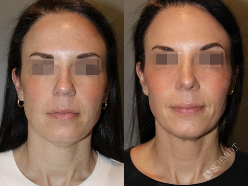 3561 - Schmidt Facial Plastic Surgery