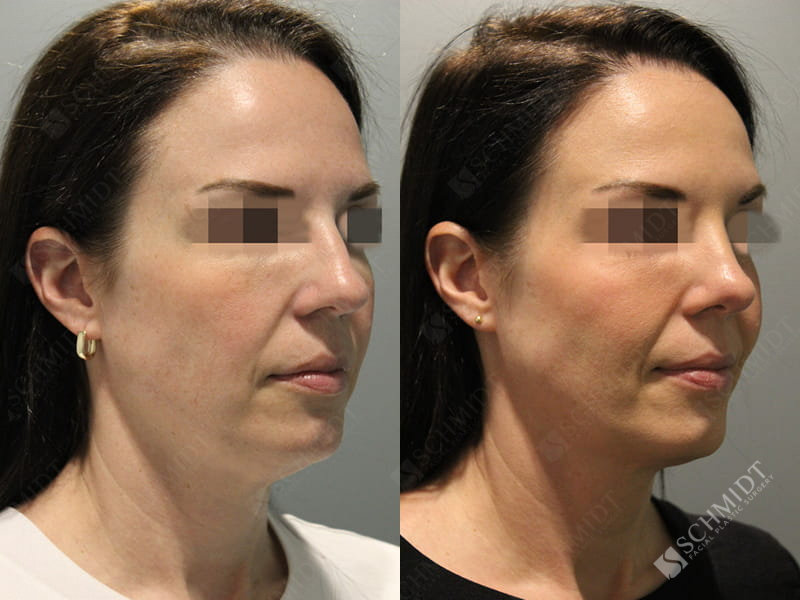 3561 - Schmidt Facial Plastic Surgery